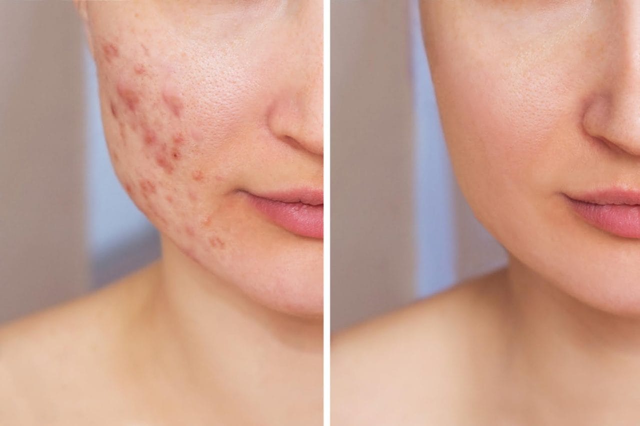 Acne Treatments: LED Therapy and Peels - Elite Facials