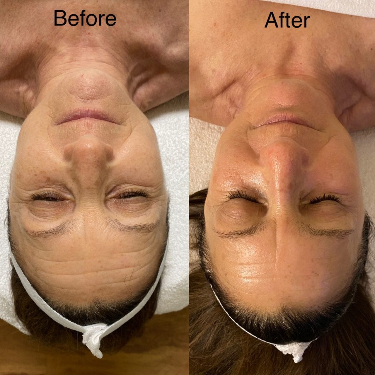 HydroSonic Infusion Facial - Elite Facials in Los Angeles and Orinda